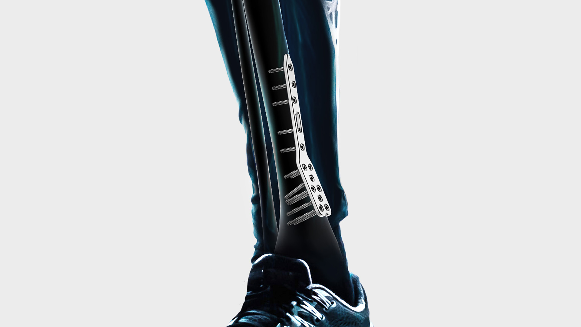 Precision Measurement of Bone Plates & Screws | ZEISS