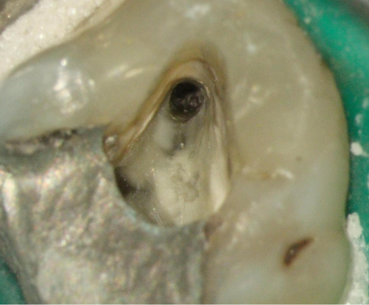 Microdentistry in Endodontics
