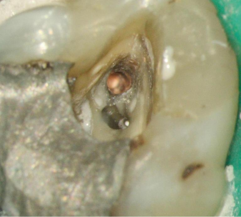 Microdentistry in Endodontics