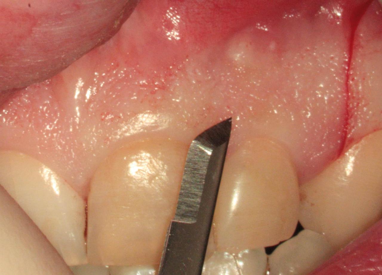 Microdentistry in Endodontics