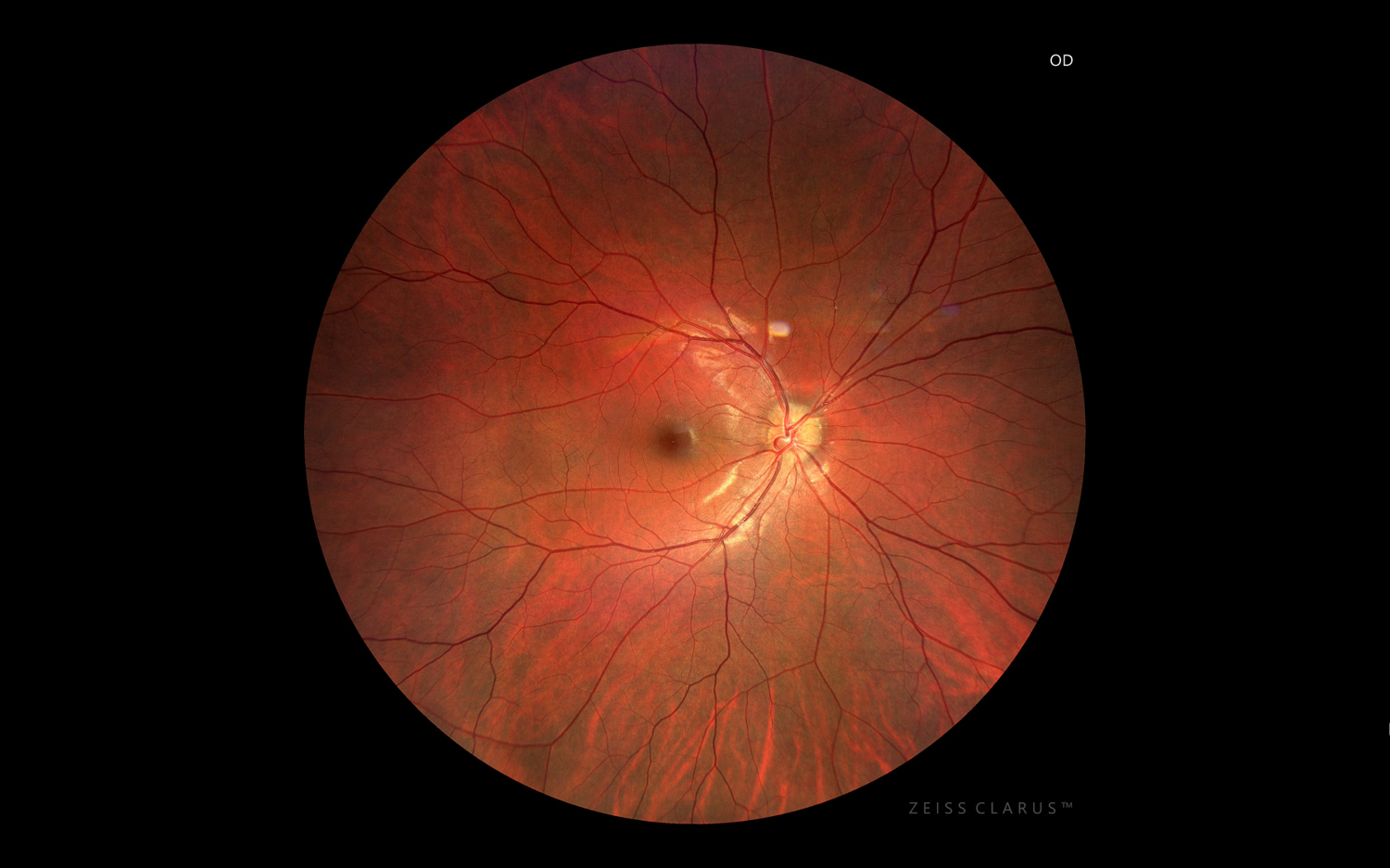 Optic Disc Drusen