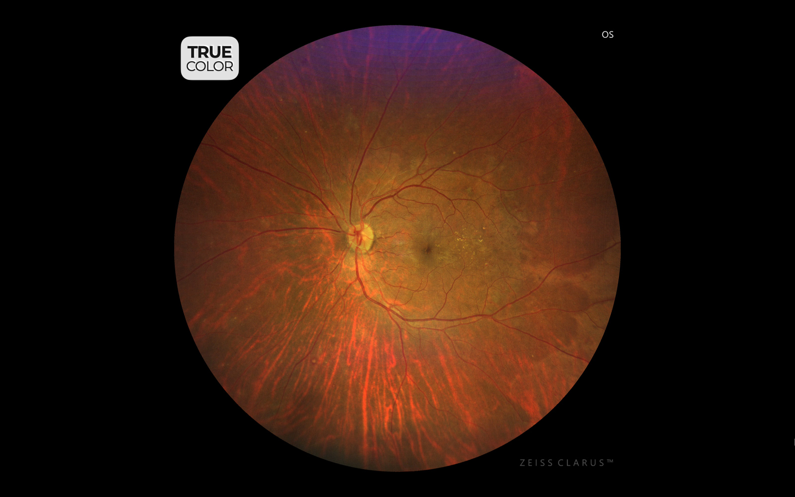 PDR with IRMA and PRP Treatment