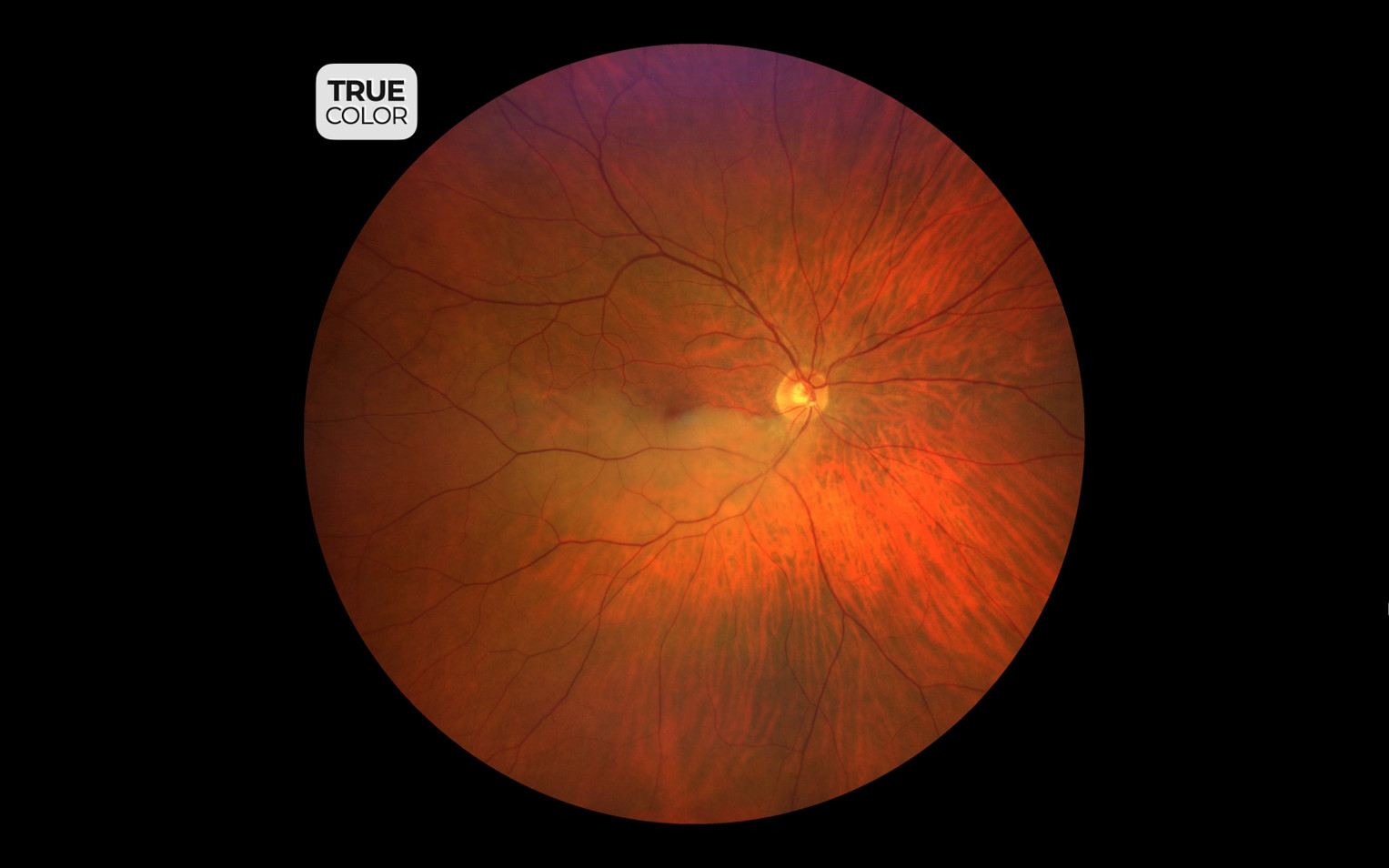 Branch Retinal Artery Occlusion Brao