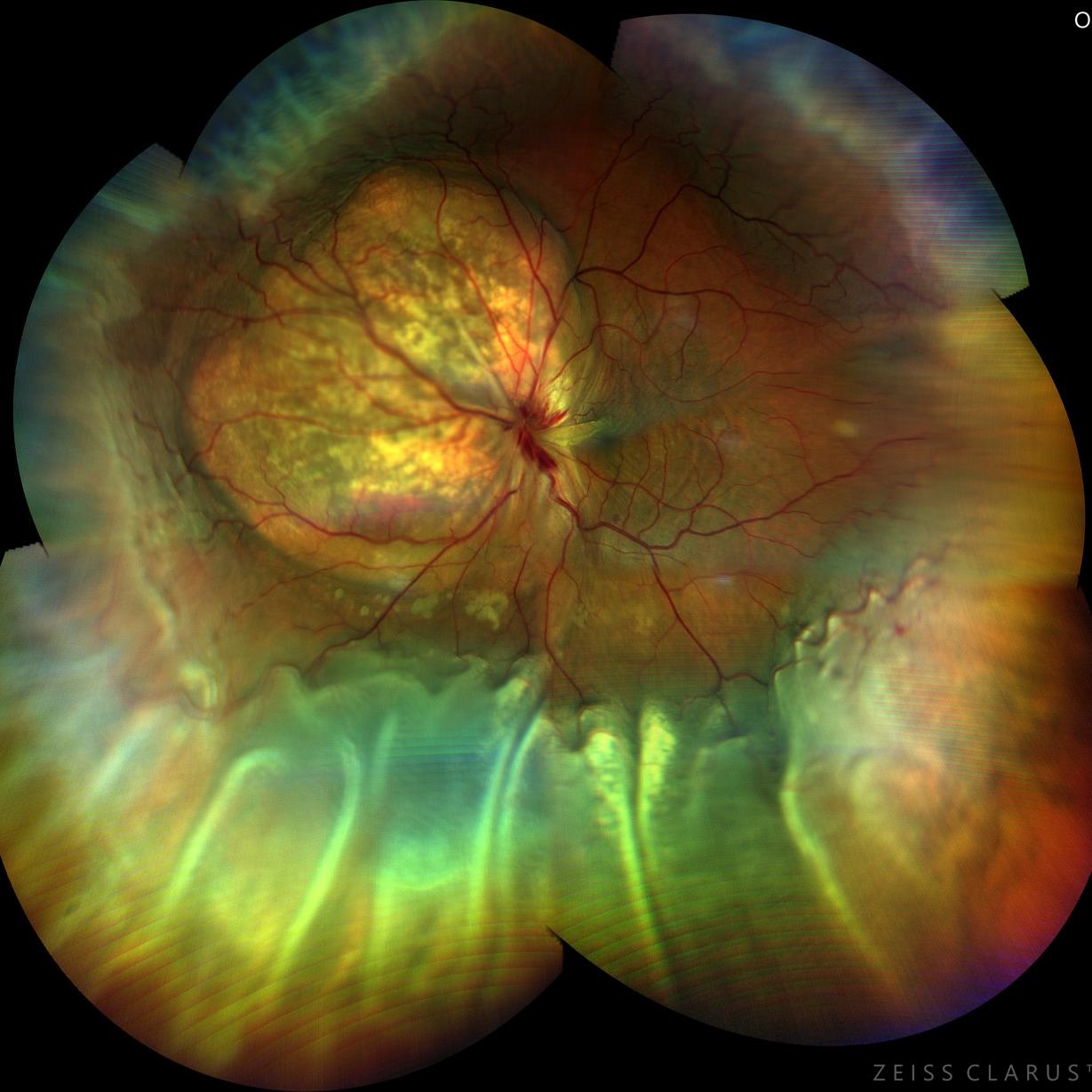 ZEISS CLARUS 500 Fundus Camera