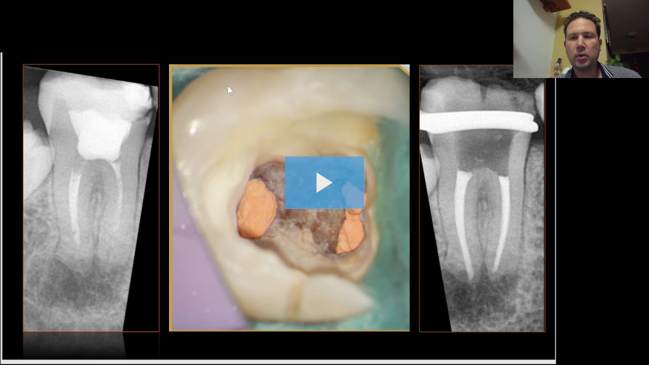 Endodontic treatment as a stage of the team approach in dental treatment