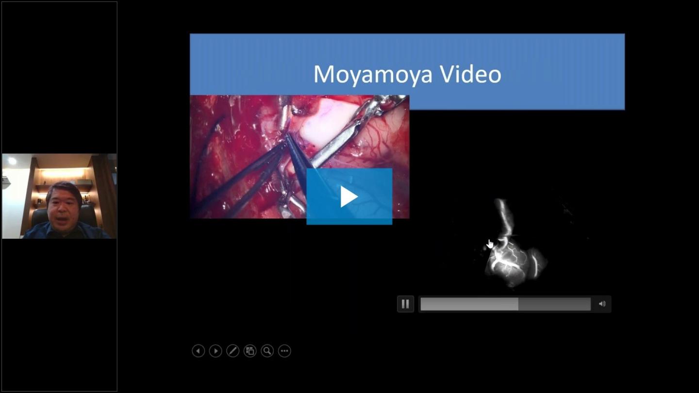 3D exoscope in neurosurgery