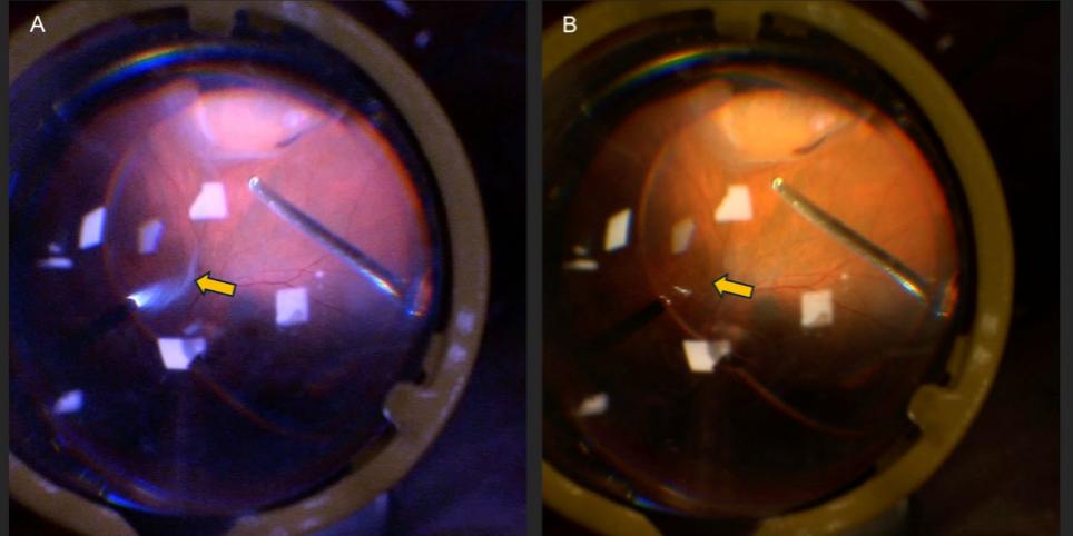 From Optical to Digital Precision: Advancing Retinal Surgery with the ...