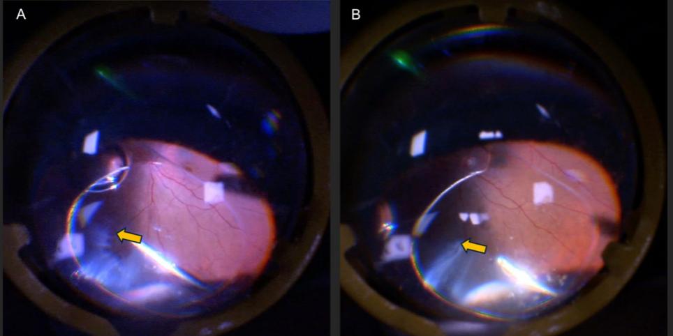 From Optical to Digital Precision: Advancing Retinal Surgery with the ...
