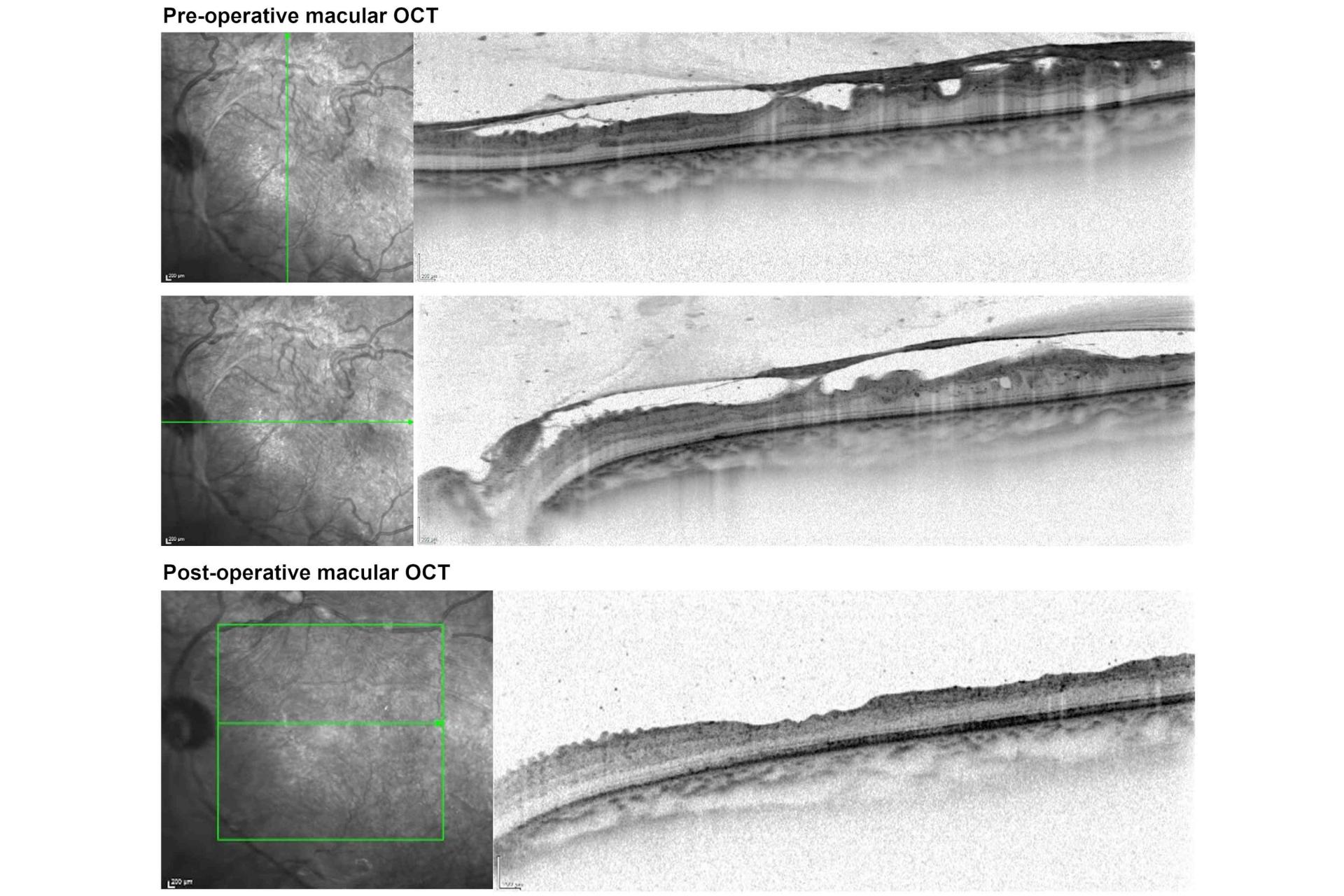 Optimizing diagnosis and surgical management of diabetic retinopathy ...