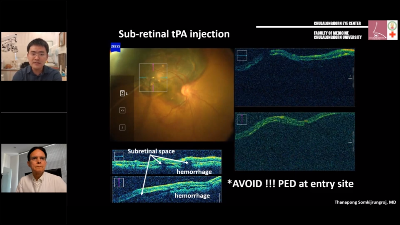 Gain more insights-using intraoperative OCT in vitreoretinal surgery