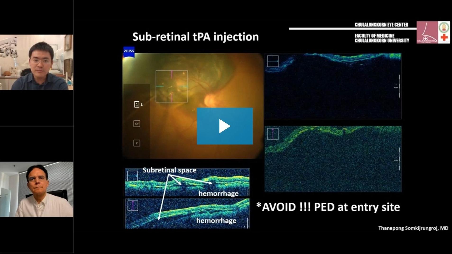 Gain More Insights Using Intraoperative Oct In Vitreoretinal Surgery