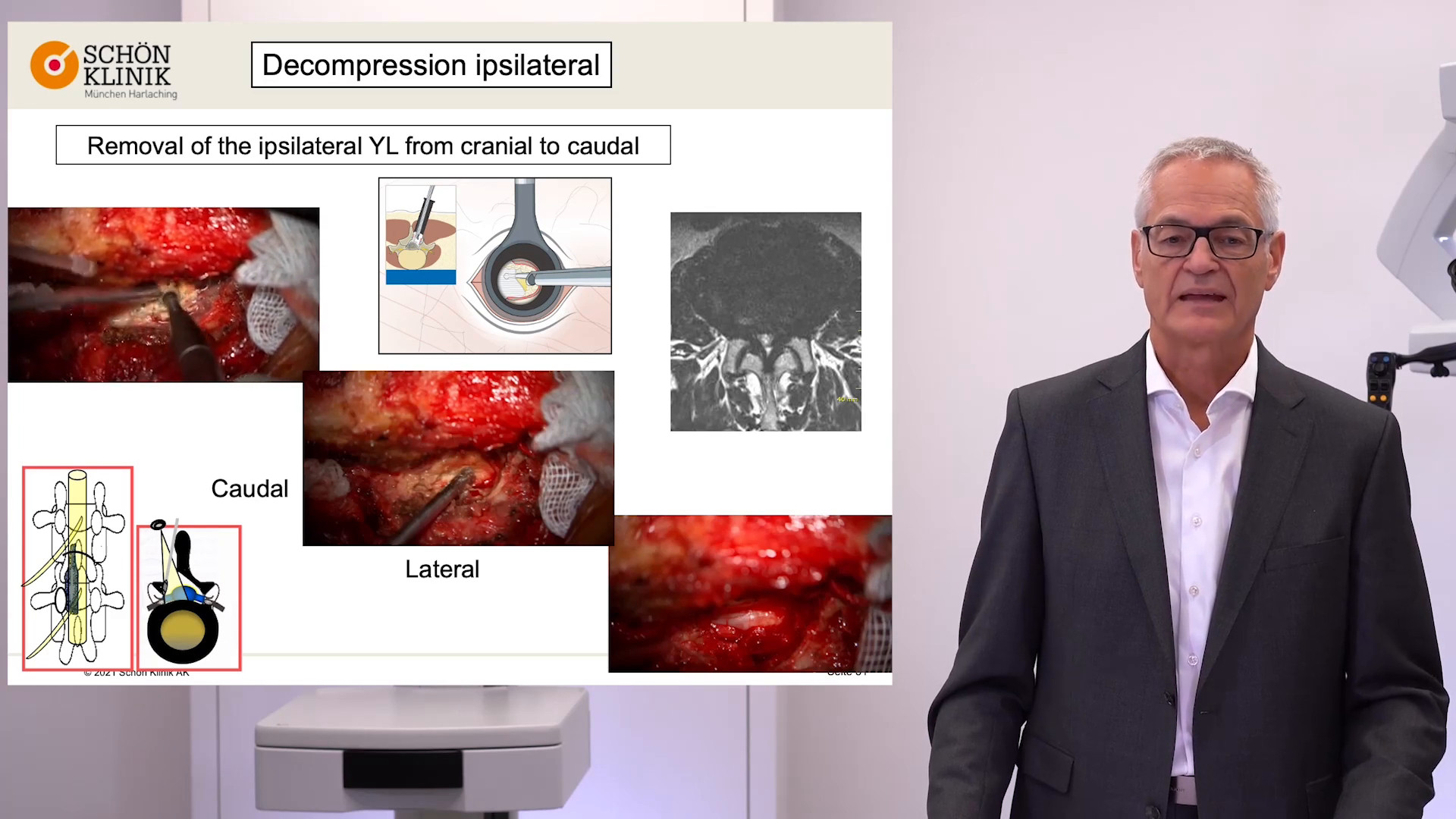 Microscope assisted bilateral cross-over decompression