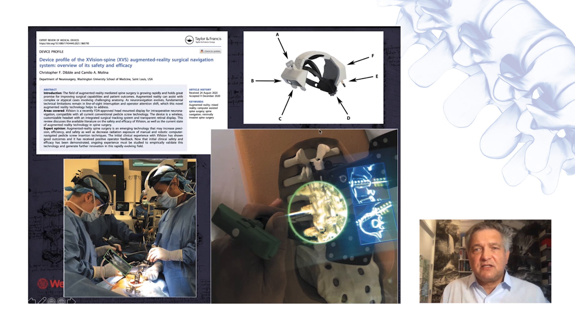 Augmented visualization in spine surgery