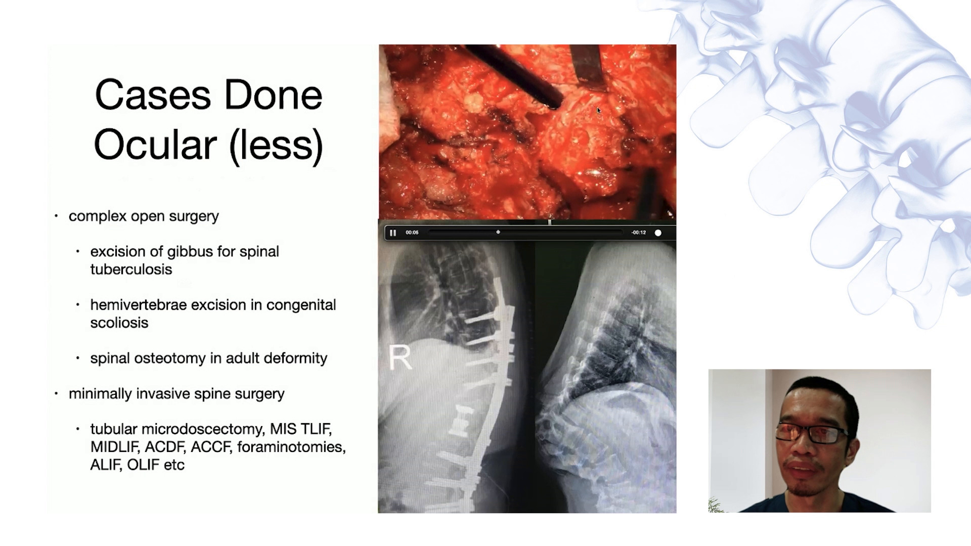 Exoscope and digital hybrid visualization in minimally invasive spine ...