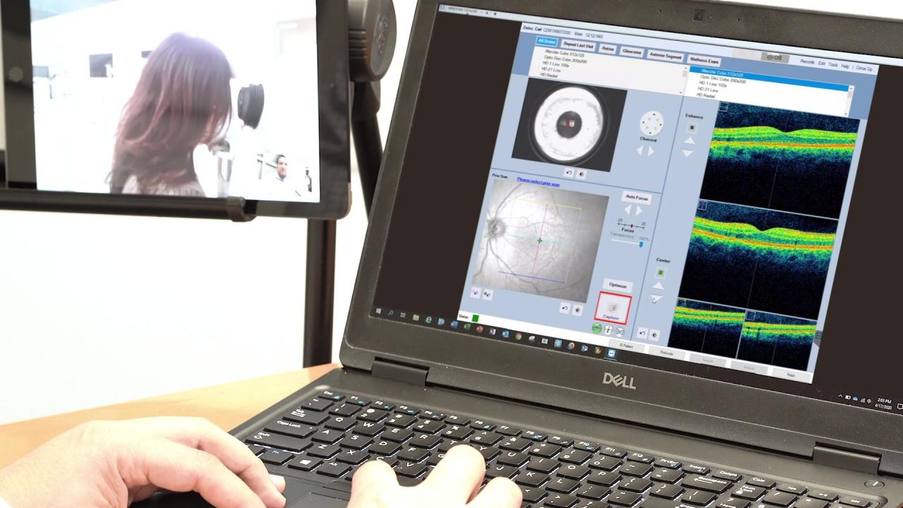 ZEISS CIRRUS OCT – Acquiring scans