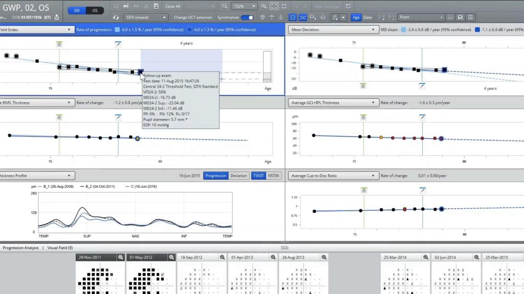 In 30 seconds: How to use ZEISS Glaucoma Workplace progression graphs