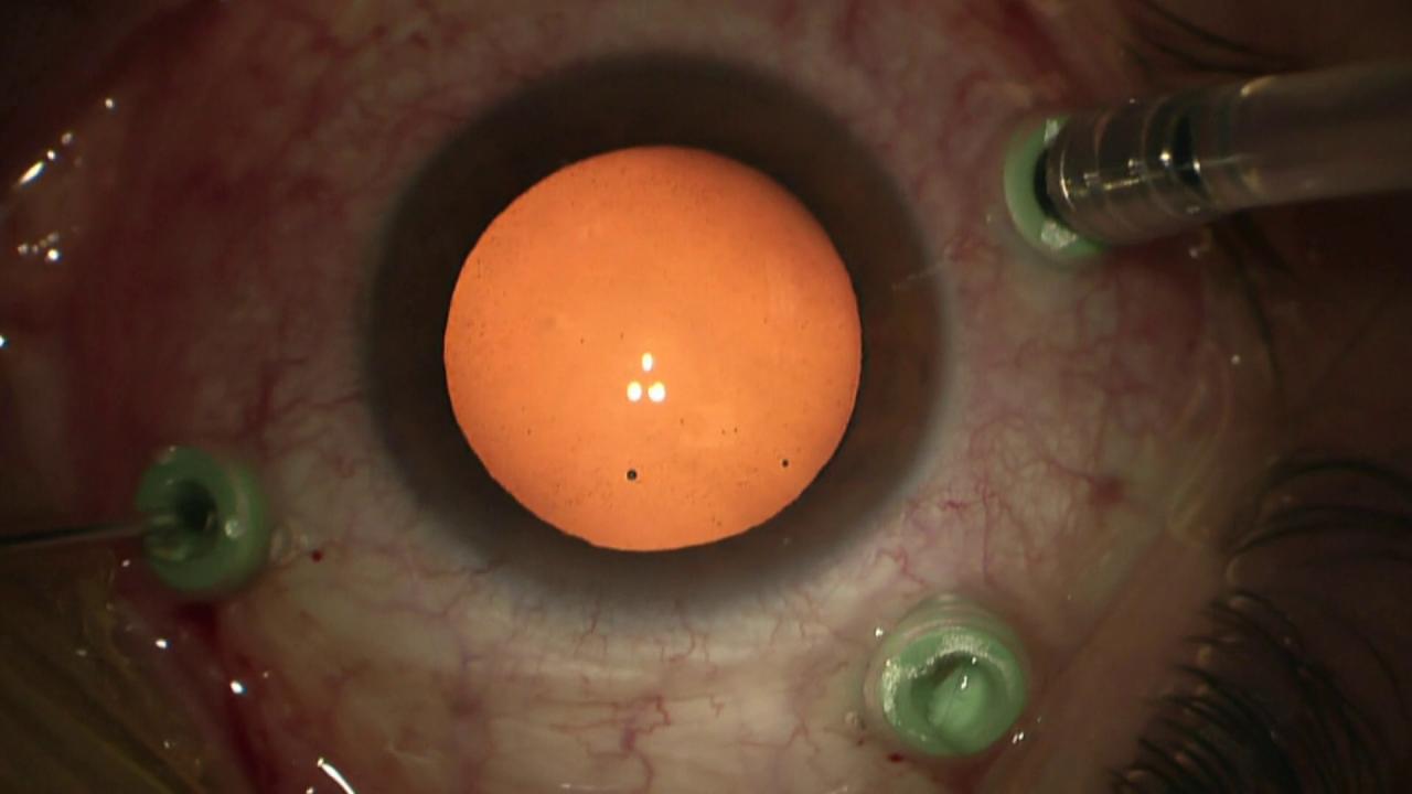 Performing retinal surgery with ZEISS RESIGHT 500/700