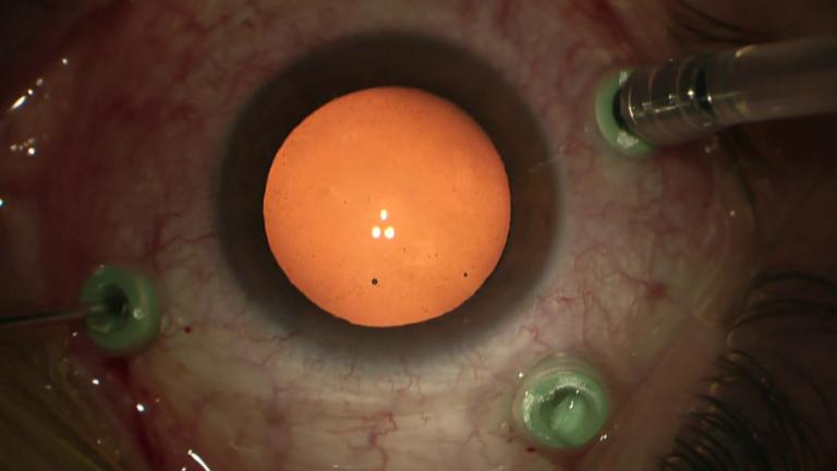 Performing retinal surgery with ZEISS RESIGHT 500/700