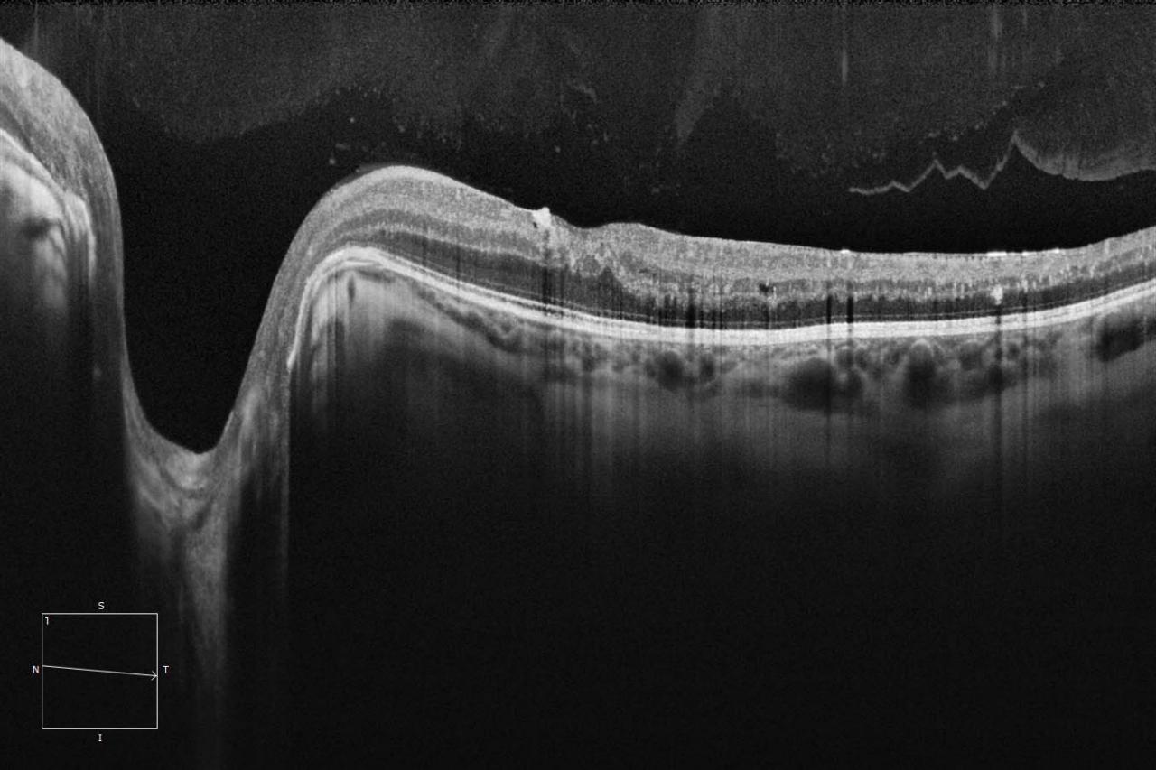 CIRRUS 6000, OCT Imaging, 100 kHz OCT system