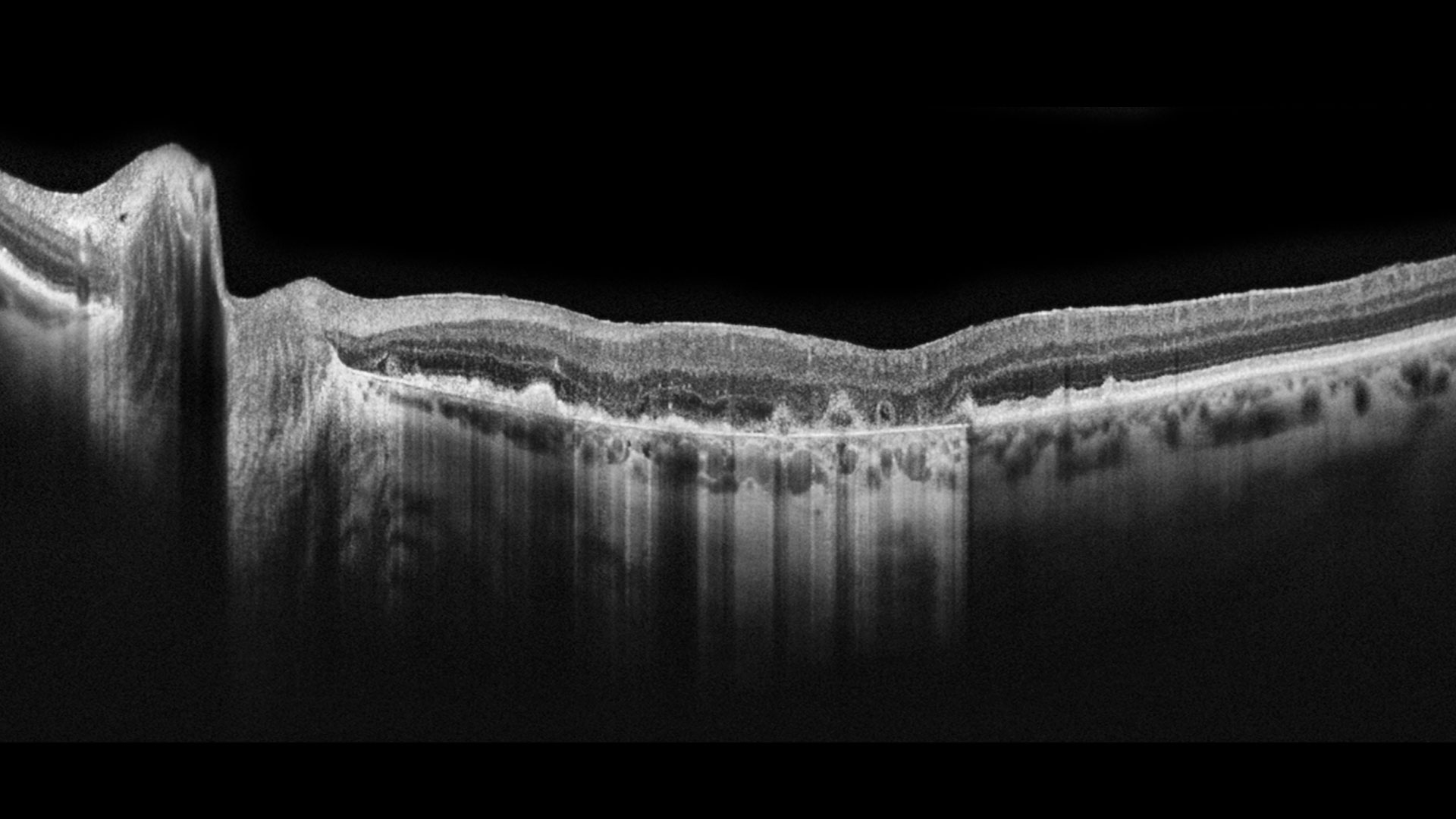 ZEISS CIRRUS 6000 | AMD and GA Tool Kit | ZEISS Medical Technology