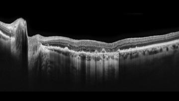ZEISS CIRRUS 6000 | AMD and GA Tool Kit | ZEISS Medical Technology