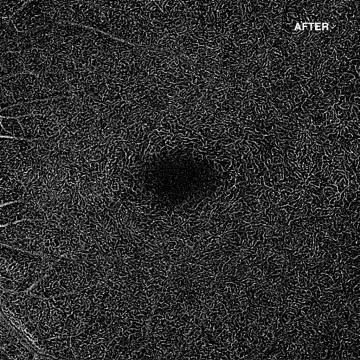 CIRRUS 6000, OCT Imaging, 100 kHz OCT system