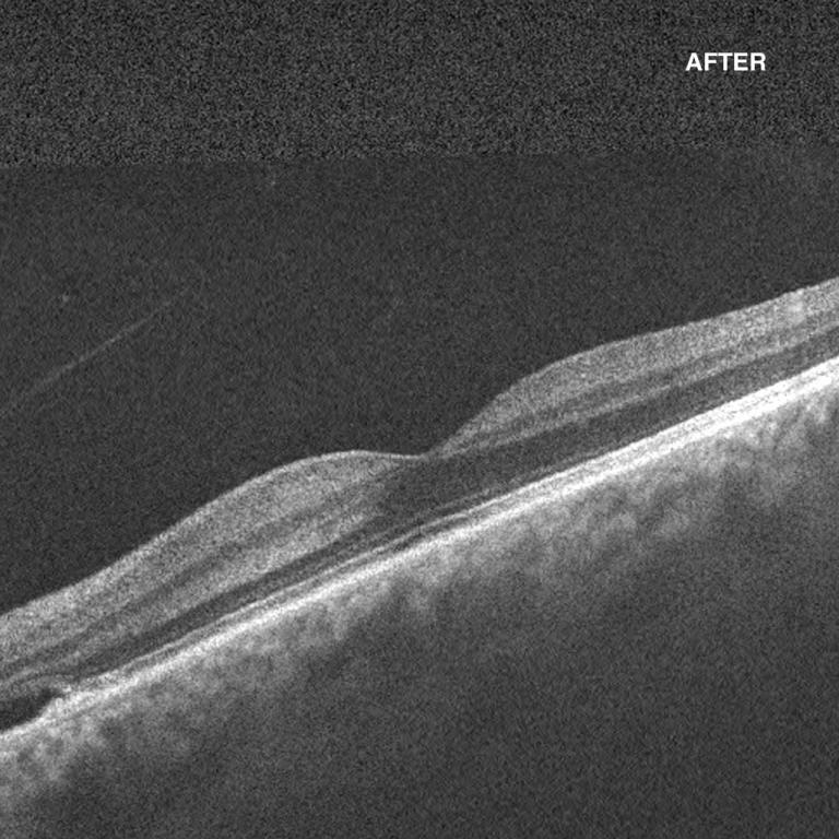 CIRRUS 6000, OCT Imaging, 100 kHz OCT system