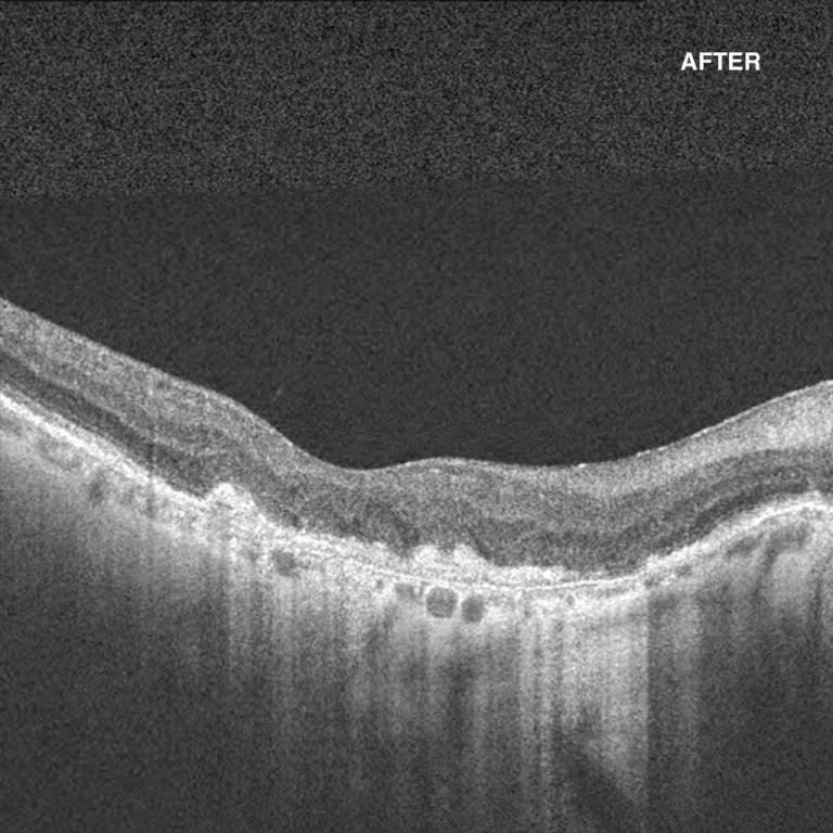 CIRRUS 6000, OCT Imaging, 100 kHz OCT system
