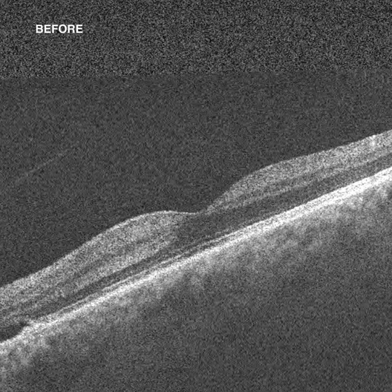 CIRRUS 6000, OCT Imaging, 100 kHz OCT system