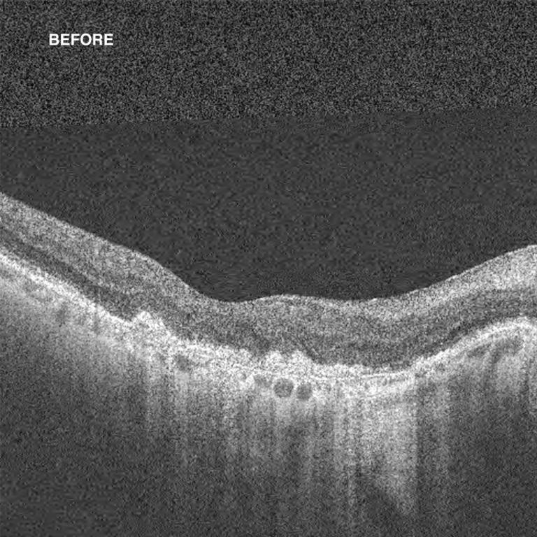 CIRRUS 6000, OCT Imaging, 100 kHz OCT system