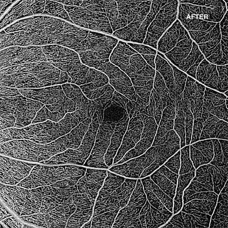 CIRRUS 6000, OCT Imaging, 100 kHz OCT system