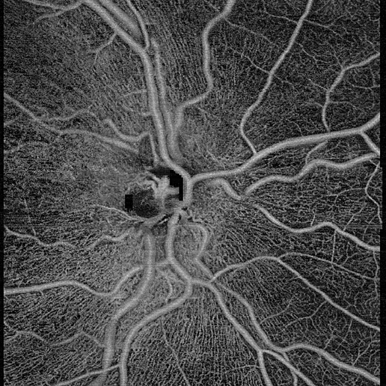 ZEISS PLEX Elite 9000 - Swept-Source OCT Angiography