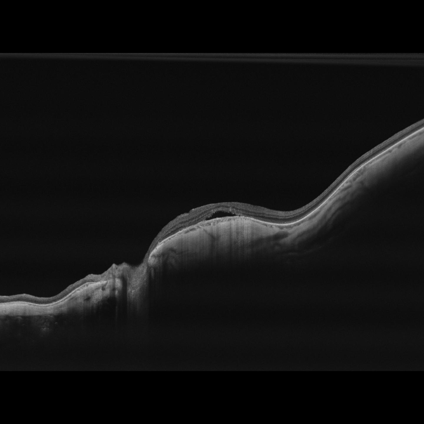 ZEISS PLEX Elite 9000 - Swept-Source OCT Angiography