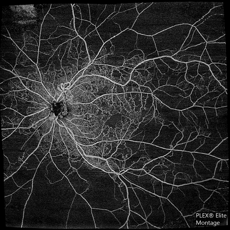 ZEISS PLEX Elite 9000 - Swept-Source OCT Angiography