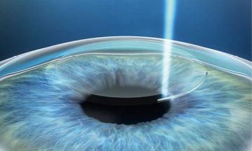 ZEISS SMILE – Femtosecond Laser Solutions