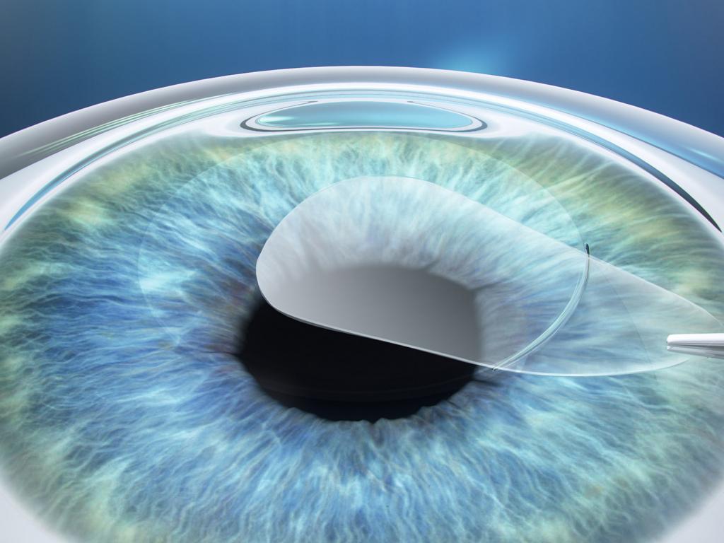 ZEISS SMILE – Femtosecond Laser Solutions