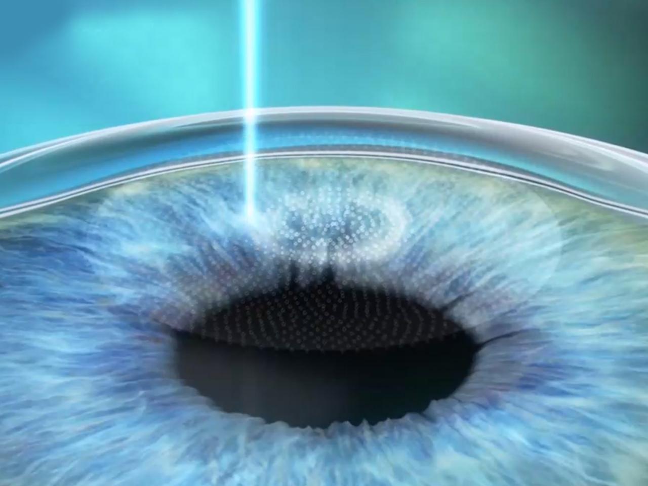 ZEISS SMILE – Femtosecond Laser Solutions