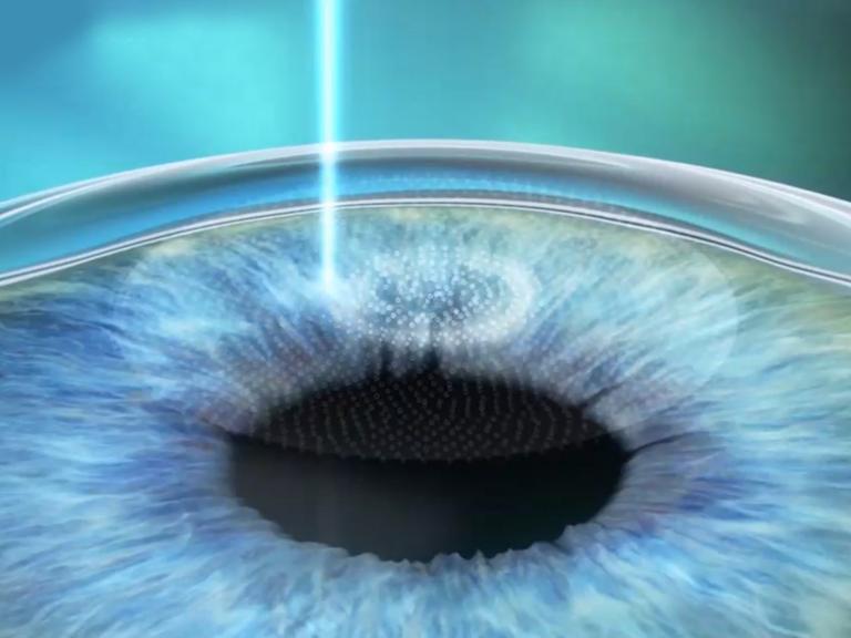 ZEISS SMILE – Femtosecond Laser Solutions