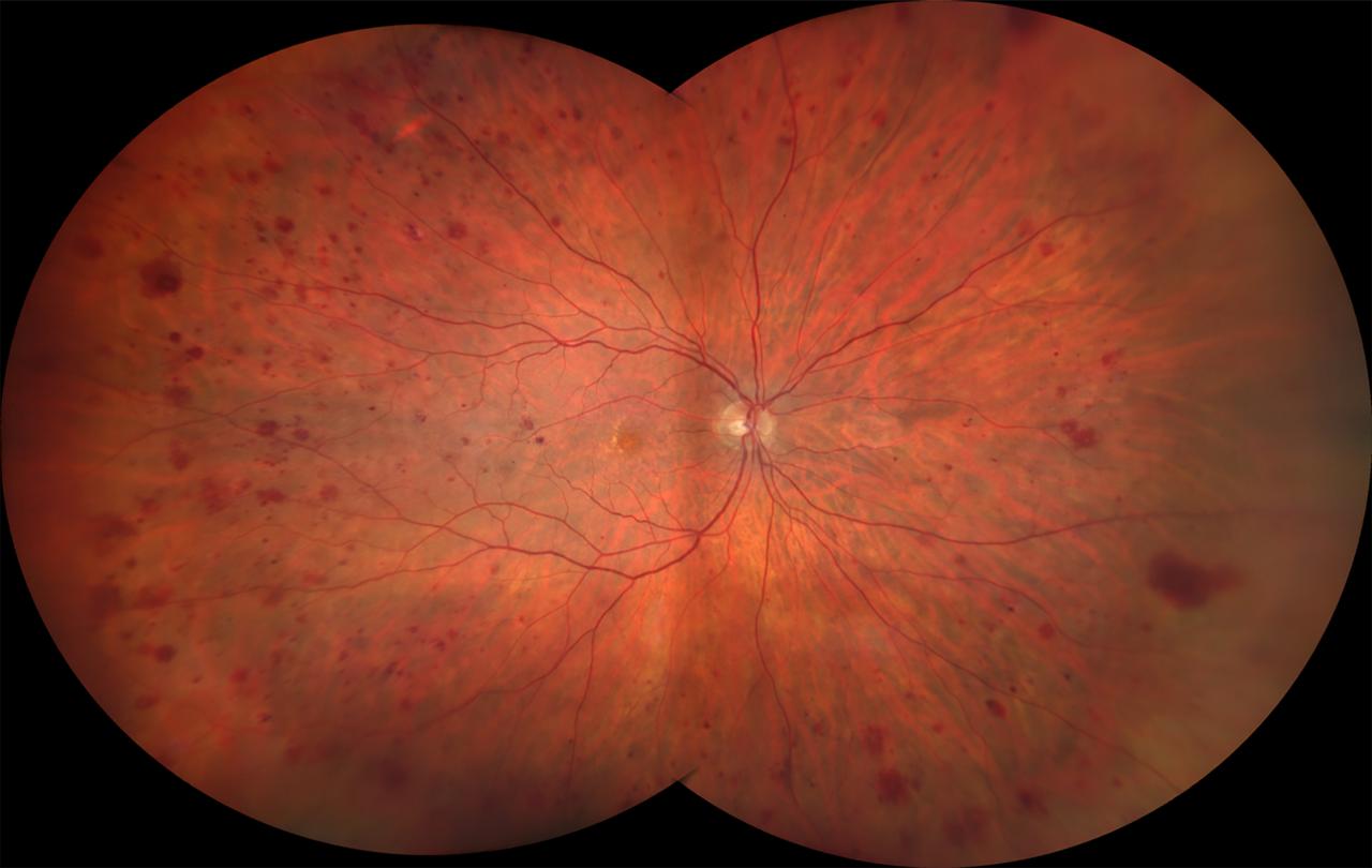 ZEISS CLARUS 500 Fundus Camera