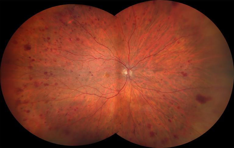 ZEISS CLARUS 500 Fundus Camera