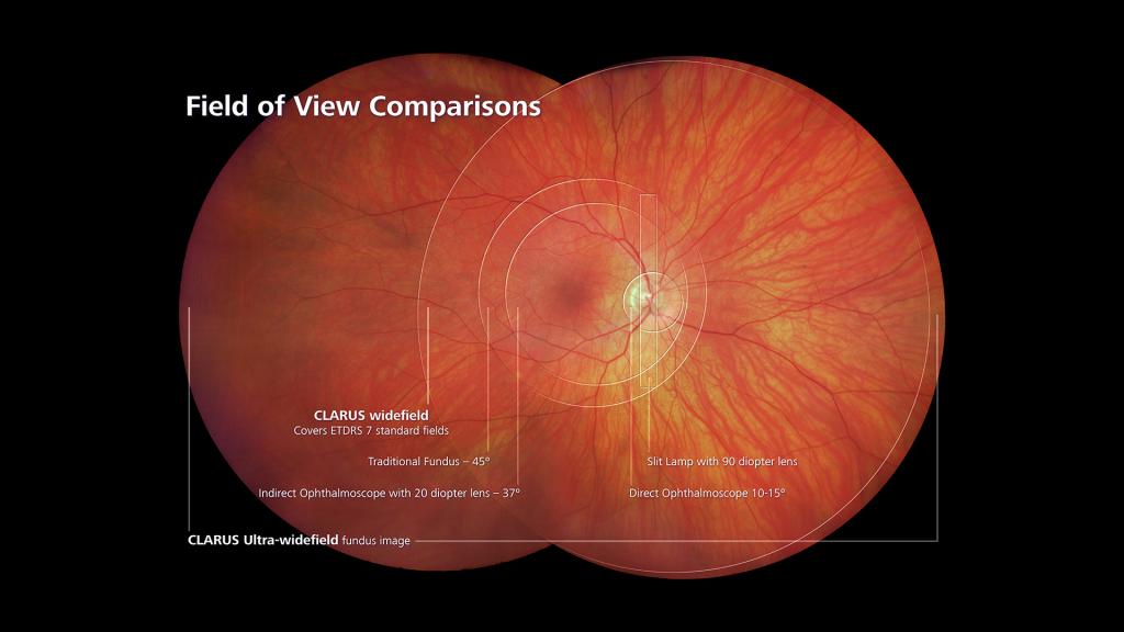 Wide View Ophthalmoscope