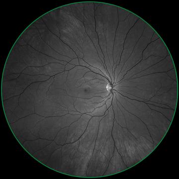 ZEISS CLARUS 500 Fundus Camera