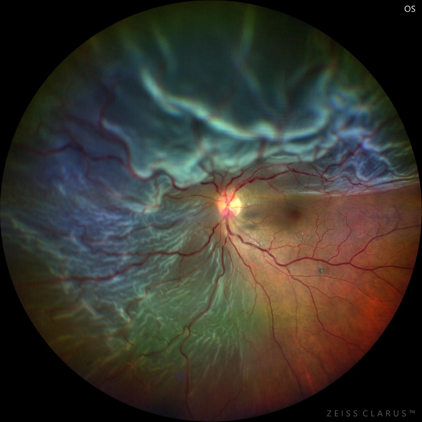 ZEISS CLARUS 500 Fundus Camera