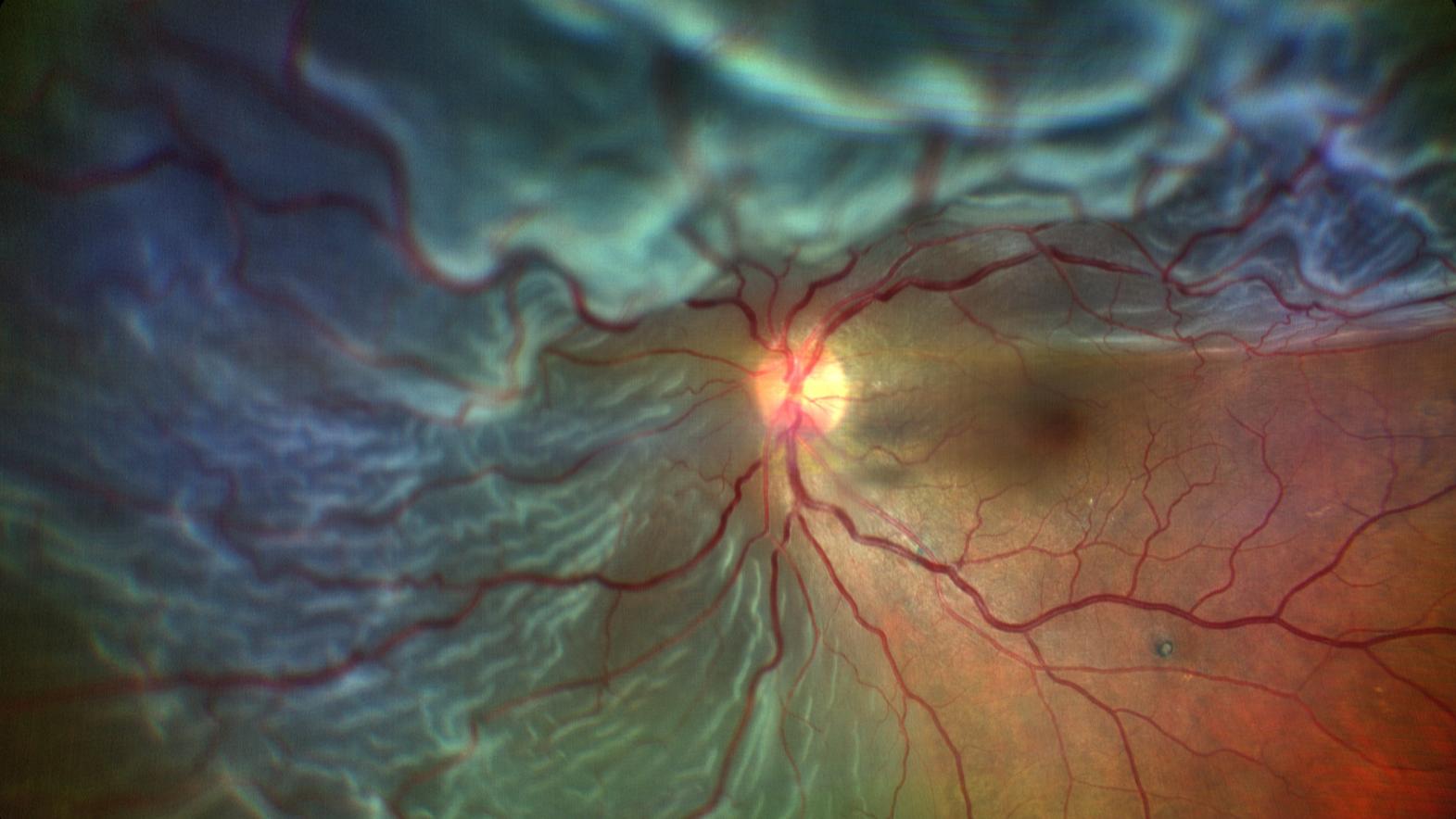 ZEISS CLARUS 500 Fundus Camera