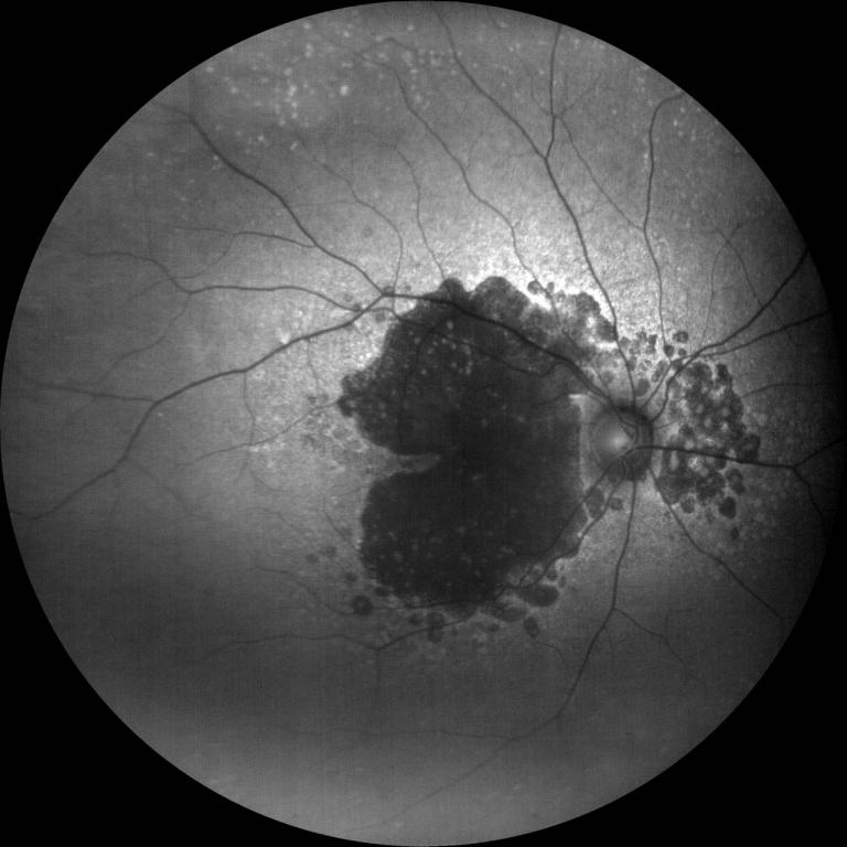 ZEISS CLARUS 500 Fundus Camera