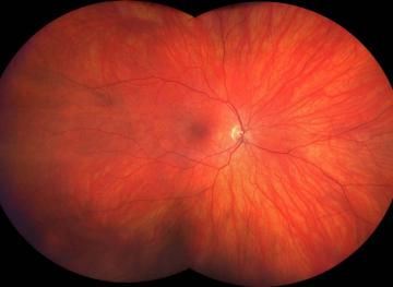 ZEISS CLARUS 500 Fundus Camera