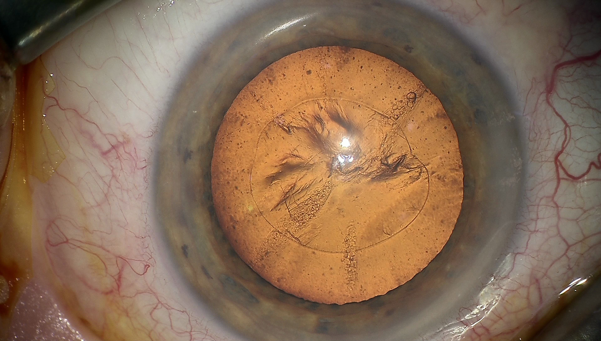 ZEISS OPMI LUMERA 300: Microscopio quirúrgico LED: Cirugía de cataratas