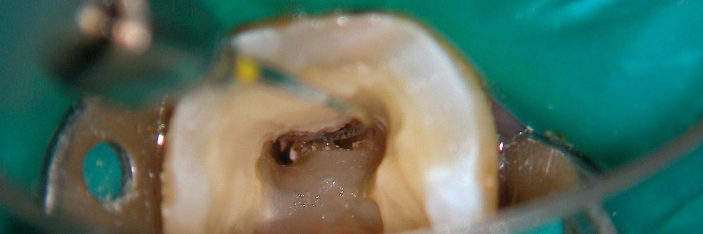 Non-surgical re-treatment