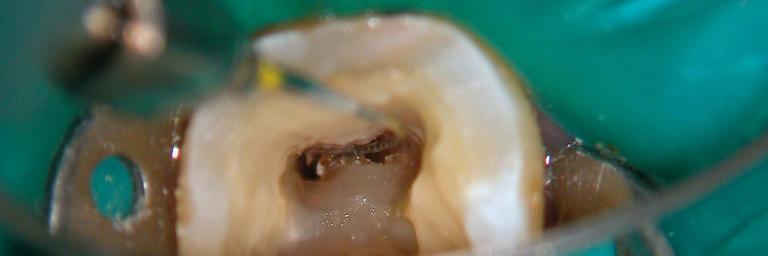 Non-surgical re-treatment