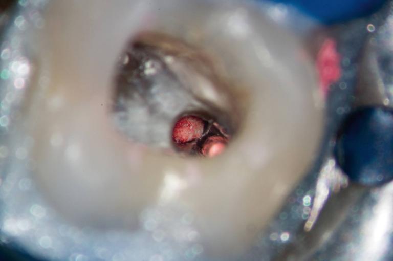 Non-surgical re-treatment